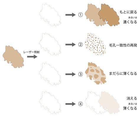 扁平母斑カフェオレ斑新宿 高田馬場 山手皮膚科クリニック
