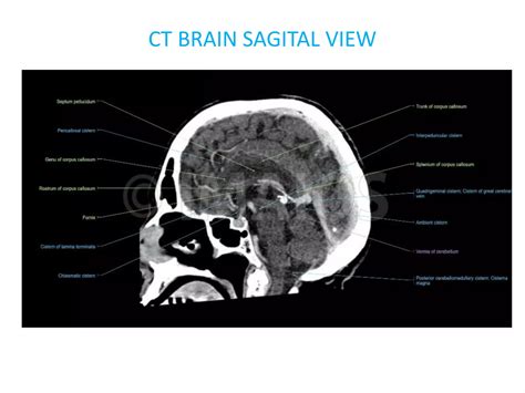 Ct Brain Anatomy Pptx