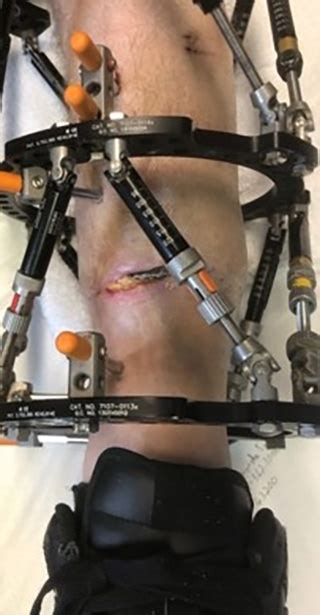 50 year old man with fracture of tibia CLLC Montréal Dre Marie Gdalevitch