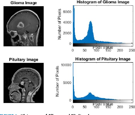 Figure 9 From Brain Tumor Classification Using Hybrid Single Image Super Resolution Technique