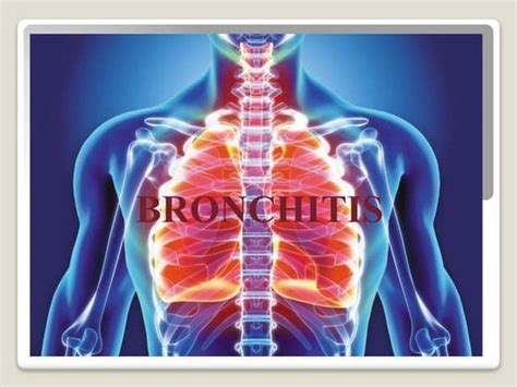 Guillain Barre Syndrom Nbbbbmbe 1 Pptx