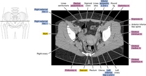 Ct Anatomy Pelvis Scan Muscle Pelvic Axial Iliacus Bone Labeled The