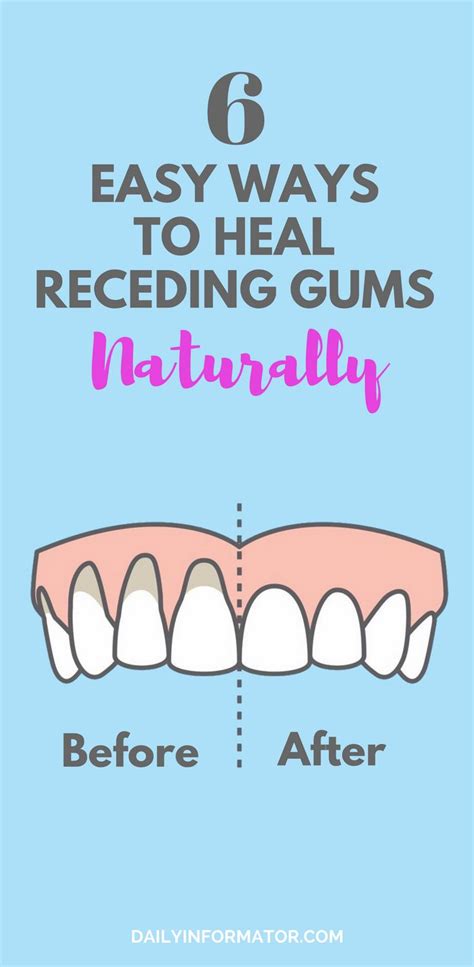 6 Easy Ways To Heal Receding Gums Naturally Oral Care Routine Oral