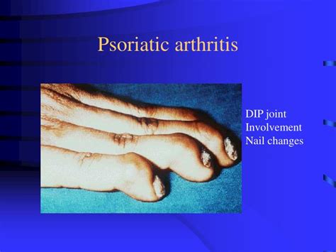 Ppt Psoriatic Arthritis Powerpoint Presentation Free Download Id