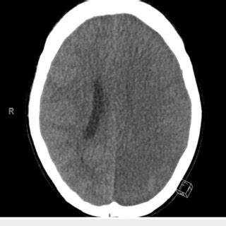 CT Scan Of The Brain Showing Diffuse Cerebral Edema With Effacement Of