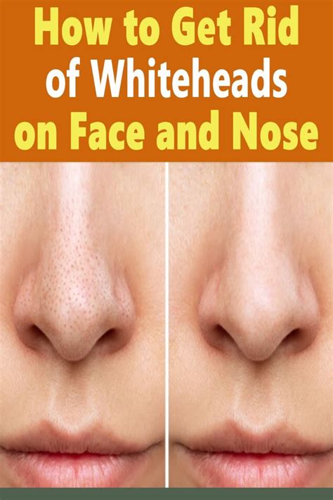 Chin Whiteheads Artofit