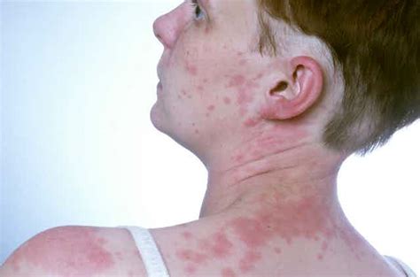 Hives