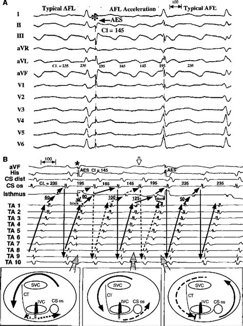Figure From Acceleration Of Typical Atrial Flutter Due To Double Wave Reentry Induced By