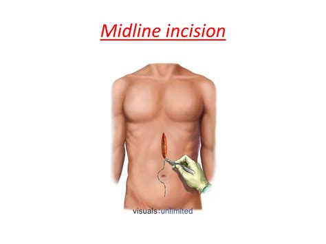 Types Of Incisions Presentation Lecture Pptx