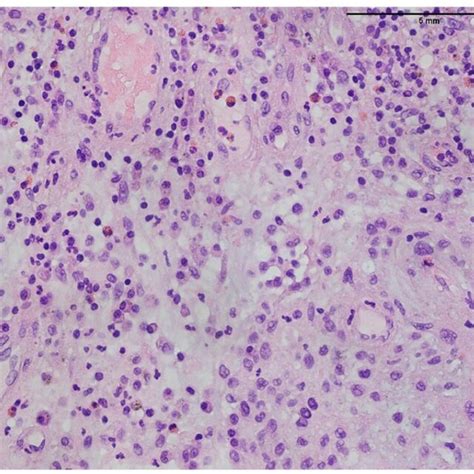 Polyp With Histiocytic Infiltrate And Mixed Inflammation 200x