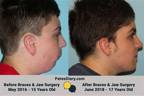 Braces Instead Of Jaw Surgery At Jacqueline Sadler Blog