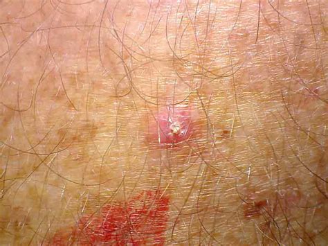 Skin Cancer Lesions On Arms