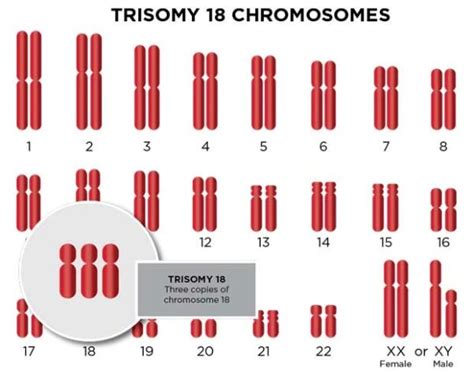 Trisomy 18 Là Gì