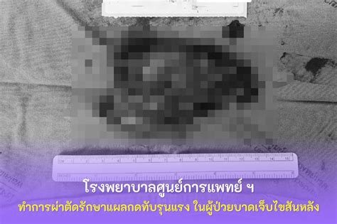 โรงพยาบาลศูนย์การแพทย์ ฯ ทำการผ่าตัดรักษาแผลกดทับรุนแรง ในผู้ป่วยบาด