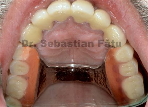 Proteza Dentara Scheletata Lucrări Dentare Complexe