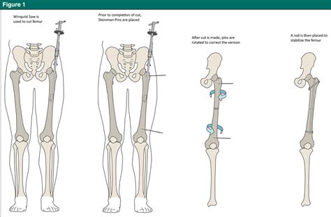 Figure 1 From Femoral Derotation Osteotomy In Adults For Version