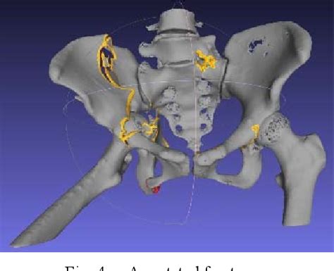 Figure 4 From An Automated Fracture Detection From Pelvic Ct Images With 3 D Convolutional