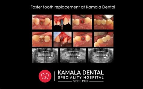 Faster Tooth Replacement At Kamala Dental Kamala Dental