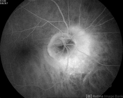 Neovascularization Of The Disc Retina Image Bank
