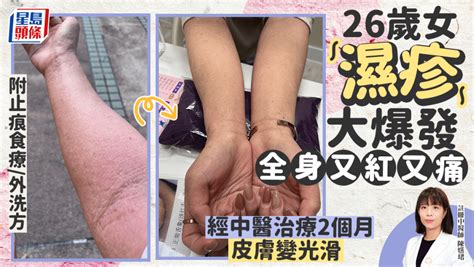 26歲女自小患濕疹常復發 全身紅腫疼痛 經中醫治療2個月變光滑 附濕疹食療