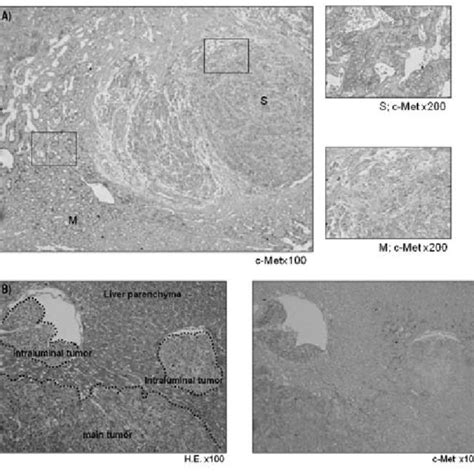 C Met Expression In Liver Metastatic Sites A In The Main Tumor C Met Download Scientific