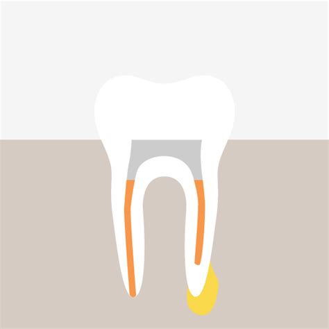 Root Canal Retreatment Thousand Oaks Endodontics
