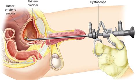 Cystoscopy Procedure A Simple Guide Asia Jarah Pishro Co