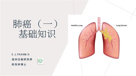 医痴说癌（九）：肺癌基础知识，非小细胞肺癌和小细胞肺癌的区别 Youtube