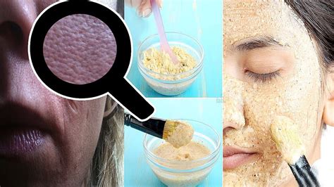 How To Get Rid Of Large Open Pores Permanently Top 5 Ways To Get Rid