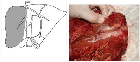 Right Hepatectomy A Right Liver Specimen With Tumor Invasion In The Download Scientific