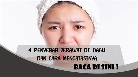 Muncul Jerawat Di Dagu Ini Penyebab Dan Cara Mengatasinya Pu