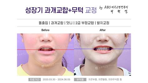 성장기 과개교합무턱교정돌출입덧니2급부정교합발치교정 전후 경주진주양산사천거제도 어린이교정치과 초등학생교정