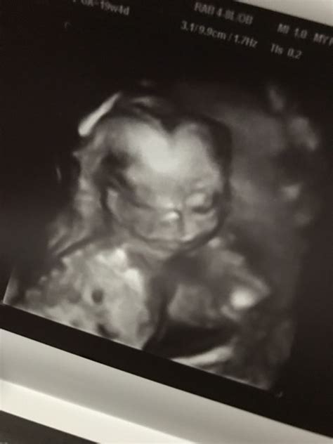 Normal 4d Scan Glow Community