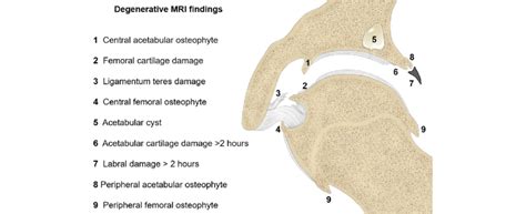 Schematic Illustration Showing The 9 Degenerative Findings Evaluated On