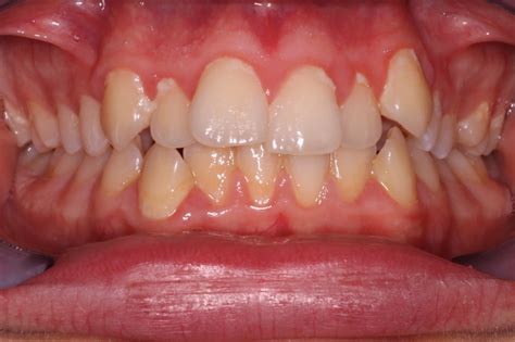 Before And Afters Braces Issaquah Invisalign Dr Dudley