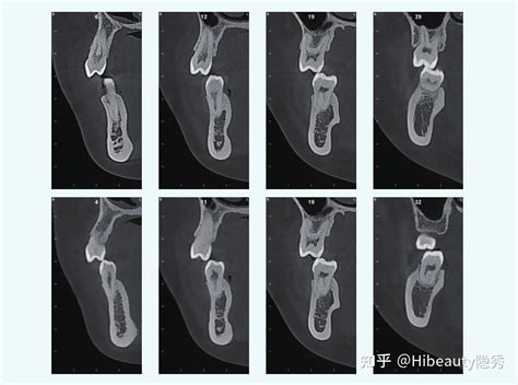 Hibeauty隐秀「牙列拥挤 单侧后牙锁牙合 骨性偏牙合代偿性矫治 」案例分享 知乎