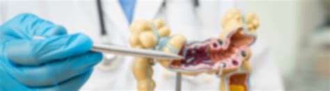 All About Polyps Colon Cancer Coalition