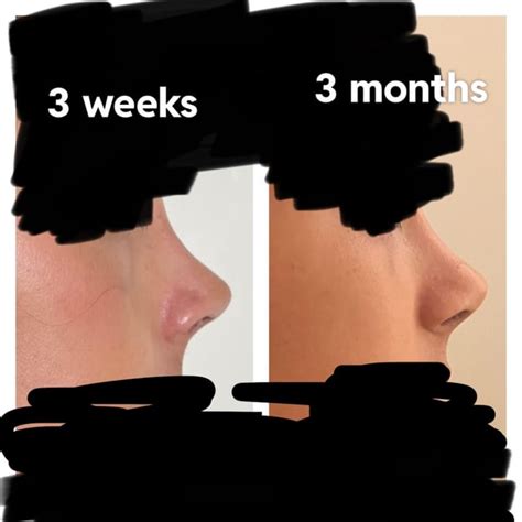 Nose Tip Drop Update 3 Weeks Vs 3 Months Tip Still Hard And Swollen