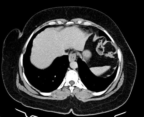 Filecholedocholithiasis Cholangitis And Portal Vein Thrombophlebitis