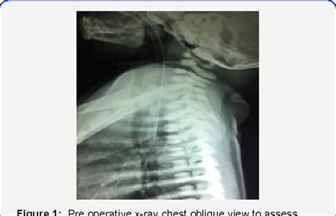 Figure 1 From Thoracoscopic Esophageal Atresia Repair First Ever