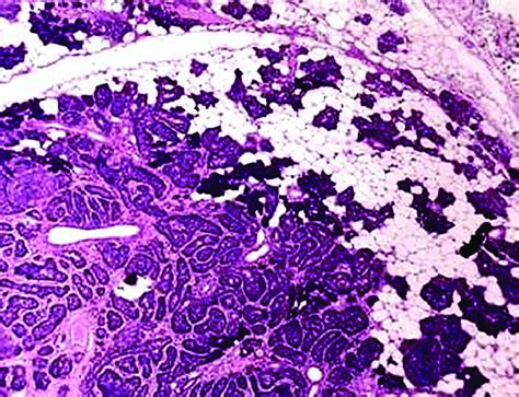 Isomorphic Cells Similar To Basaloid Cells With Palisading Arrangement Download Scientific