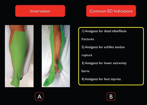 Popliteal Nerve Block Distribution