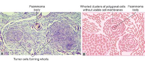 Psammoma Bodies Vs Keratin Pearls
