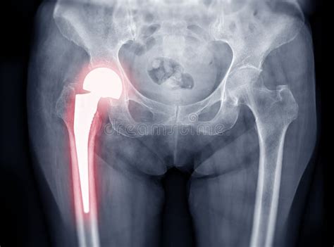 X Ray Image Of Right Ankle Joint AP And Lateral View Stock Photo Image Of Examination Human