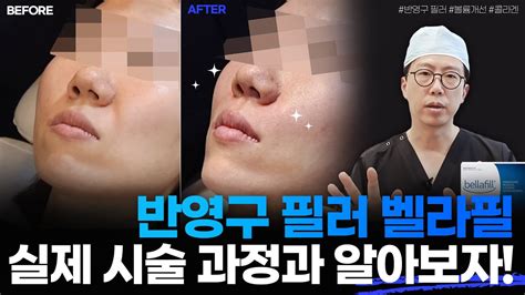 10년 유지 반영구 필러 벨라필 ㅣ Fda 승인을 받은 안전한 필러 ㅣ 주름 및 볼륨 개선하기 팔자주름 팔자주름필러