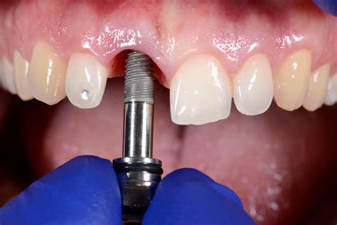 Dental Implants In Virginia Beach VA Dental Implants In Chesapeake VA Advanced Sedation
