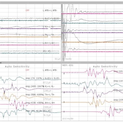 Image Showing Intraoperative Mep Monitoring Screenshots Download Scientific Diagram