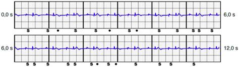 Safety And Performance Of The Subcutaneous Implantable Cardioverter