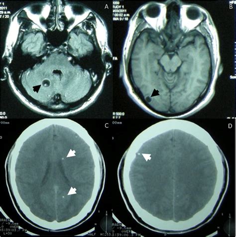 Improved Diagnosis Of Viable Parenchymal Neurocysticercosis By