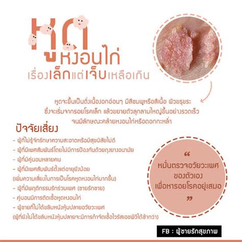 ทำไงดีคับ ผมเป็นหูดหงอนไก่ที่อวัยวะเพศแต่ผมไม่เคยมีsexกับใครเลย